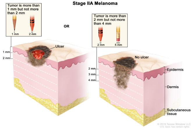 What is Stage II melanoma? - The Melanoma Nursing Initiative