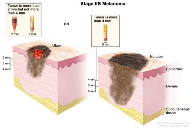 What is Stage II melanoma? - The Melanoma Nursing Initiative
