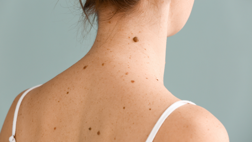 Non-Invasive Genetic Sticker - The Melanoma Nursing Initiative